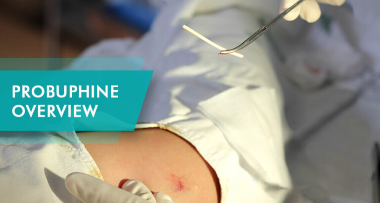 Probuphine Implant Cost And Success Rates: Durability