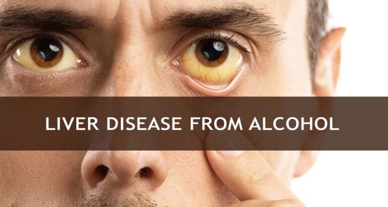 Alcoholic Liver Disease − Symptoms, Stages and Treatment Options