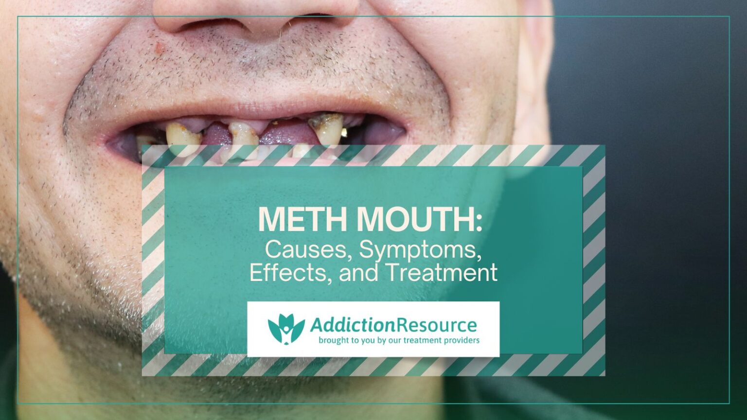 Meth Mouth Explained: What Causes It, And How to Deal With It