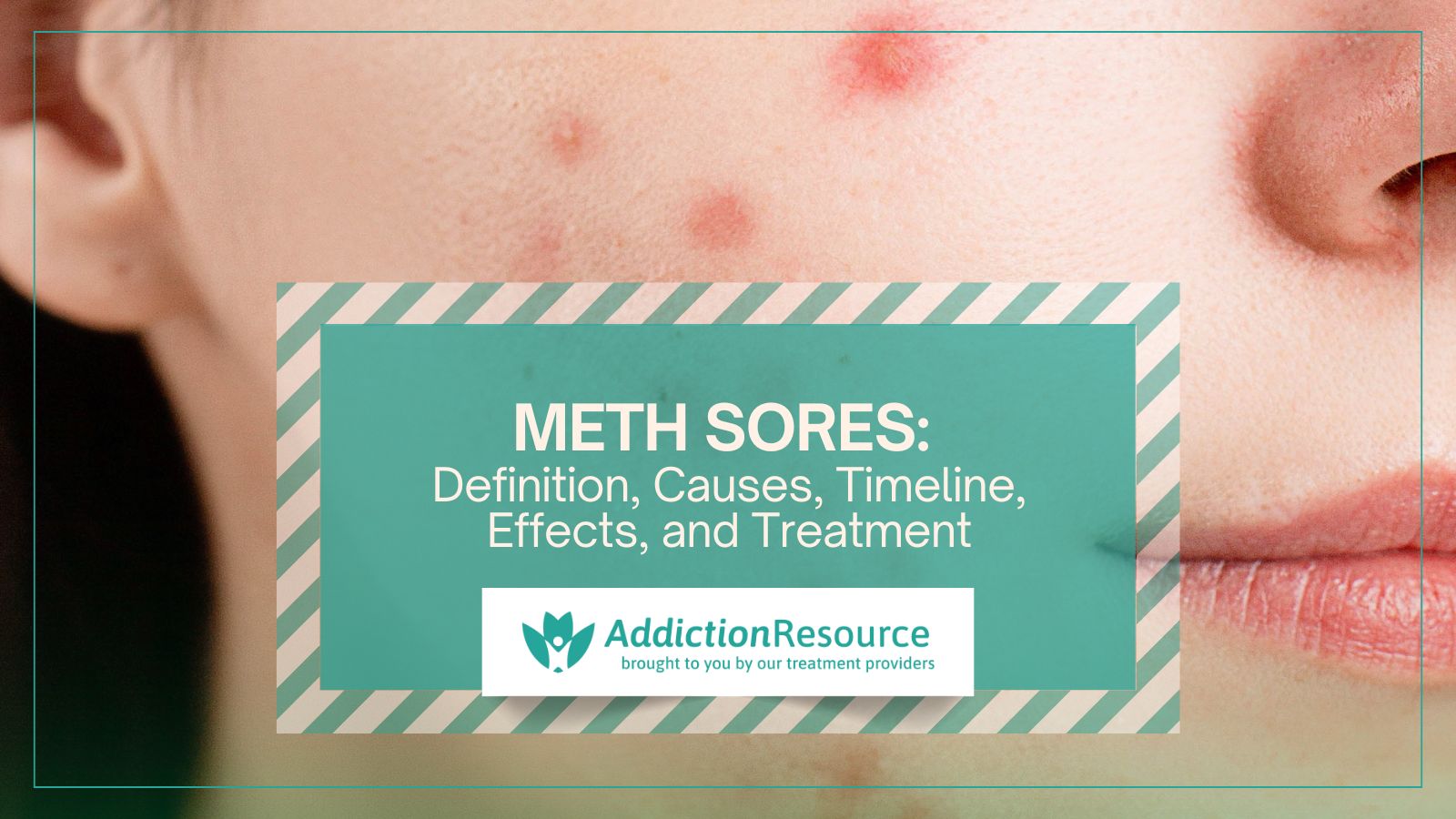 Meth Bites Skin Condition